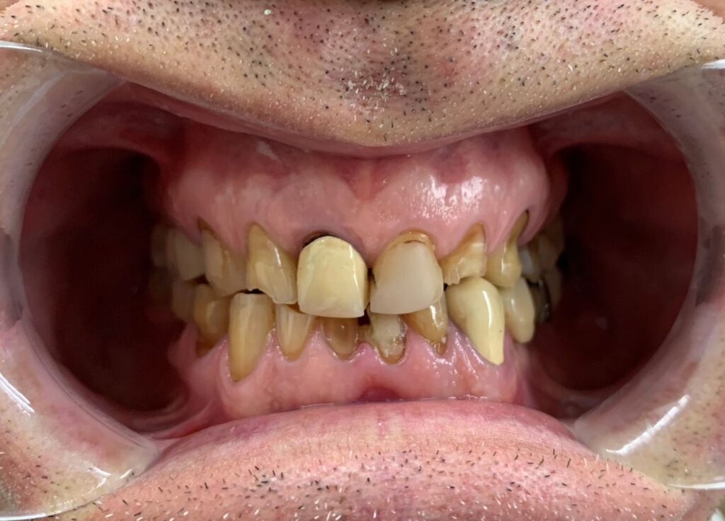 Upper and lower jaw restoration in a patient with bruxism - Smile ...
